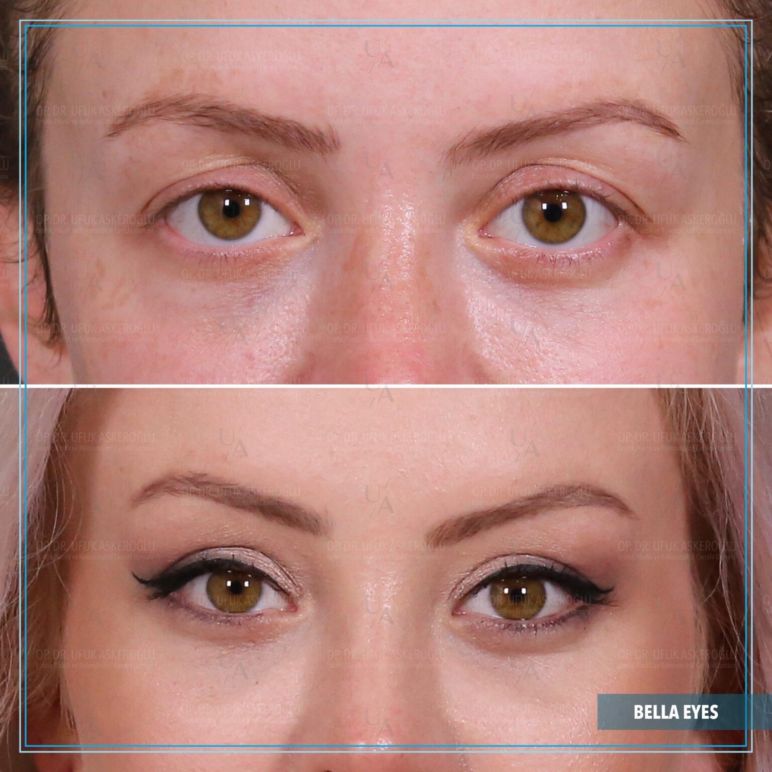 Bella Eyes Surgery - Ufuk Askeroğlu