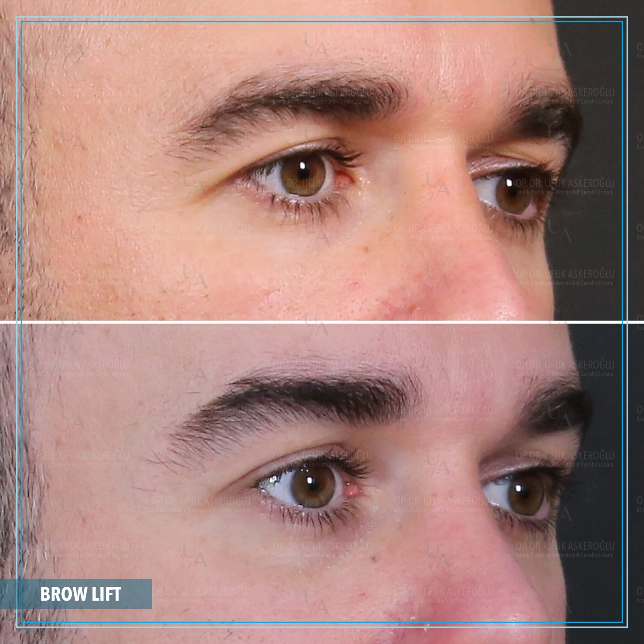 Endoscopic Medial Brow Lift - Ufuk Askeroğlu