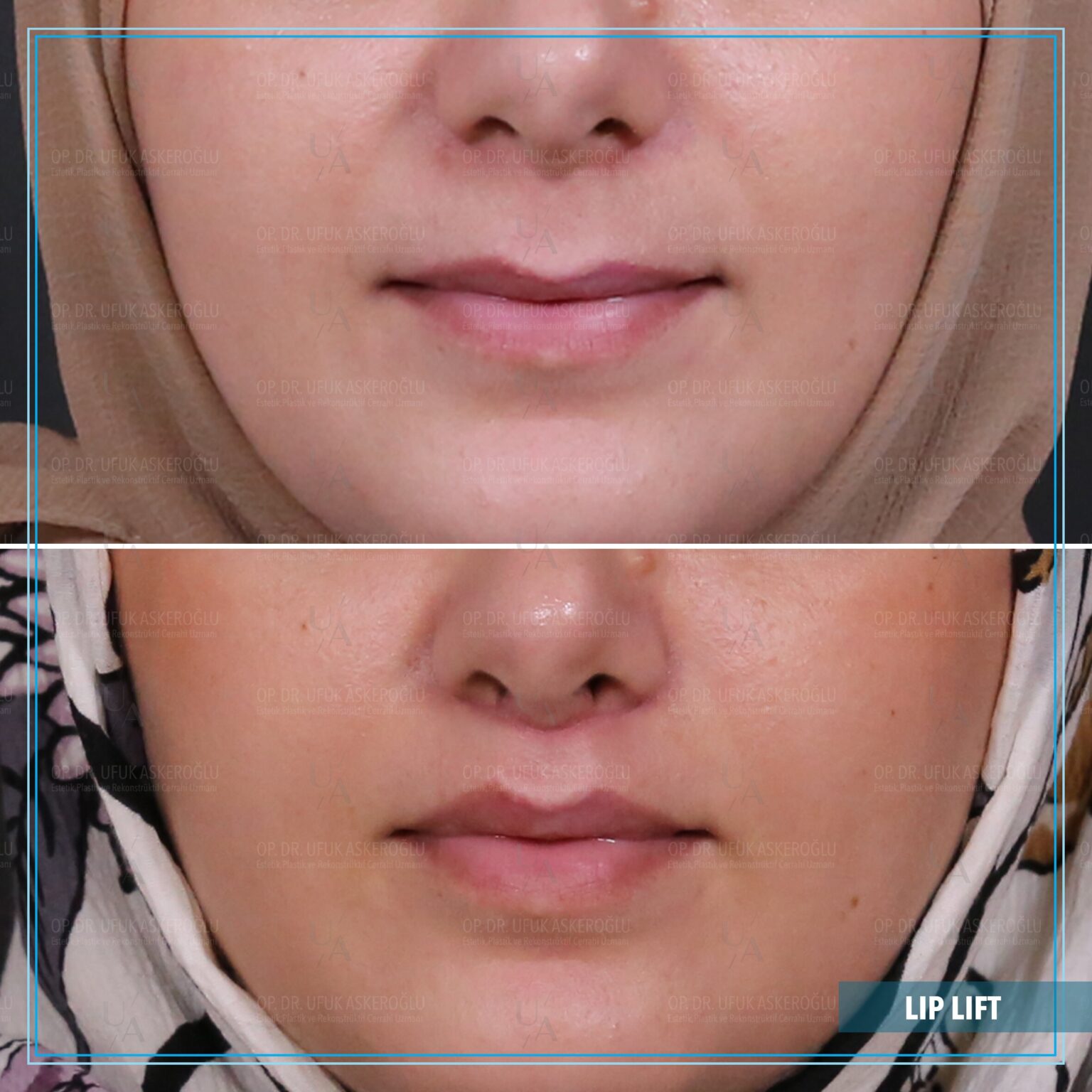 Lip Lift Surgery Turkey - Ufuk Askeroğlu