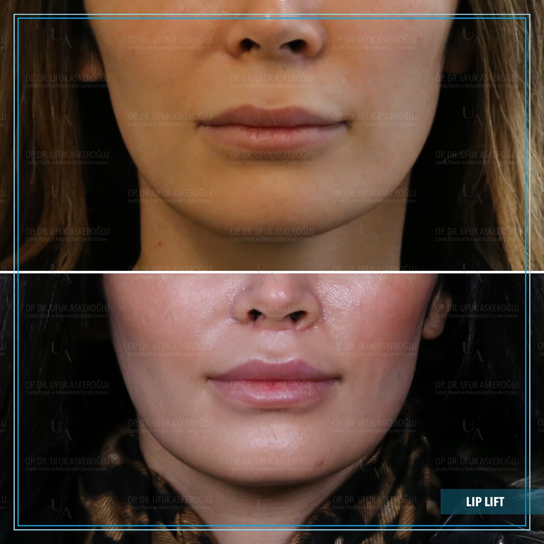 Lip Lift Surgery Turkey - Ufuk Askeroğlu