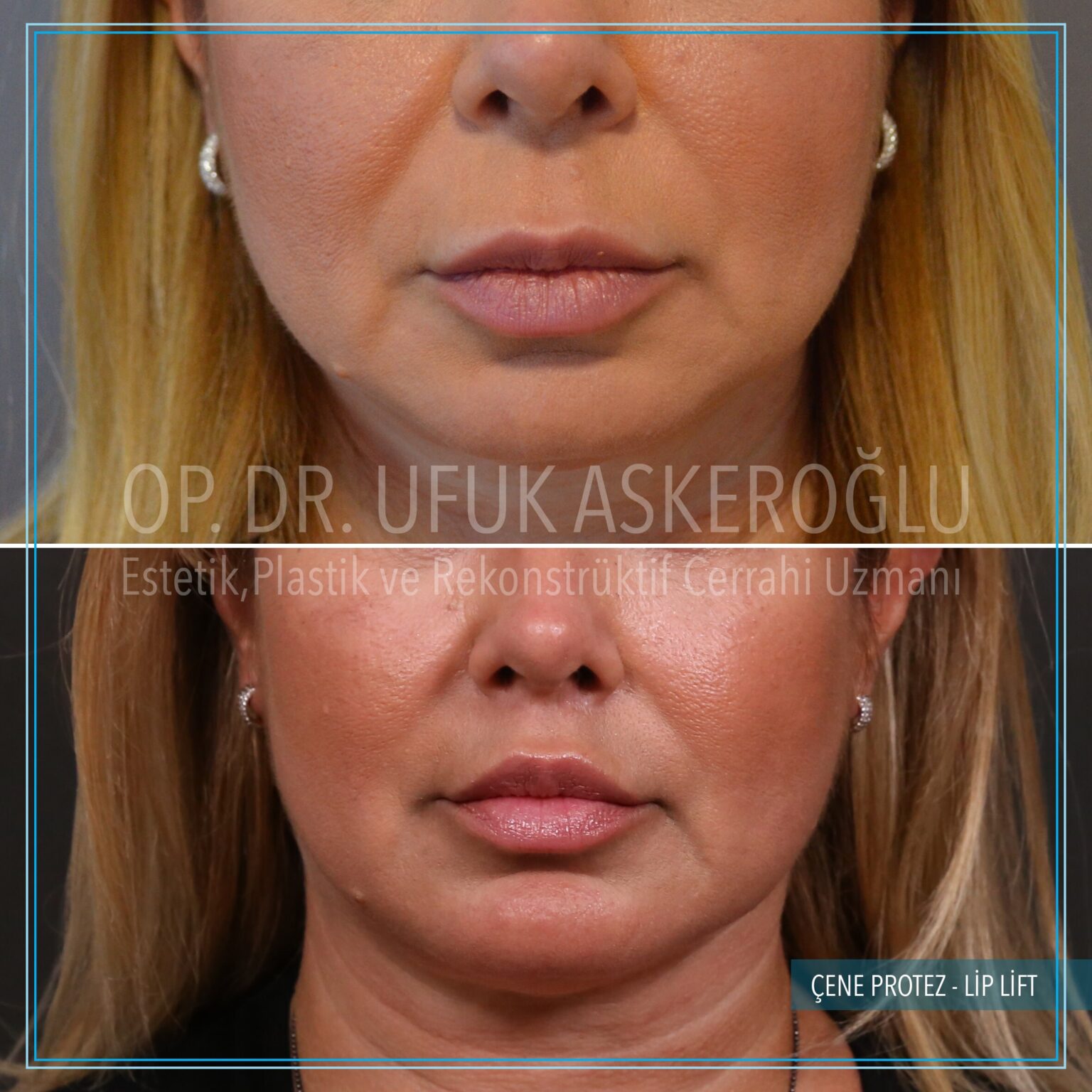 Lip Lift Surgery Turkey - Ufuk Askeroğlu