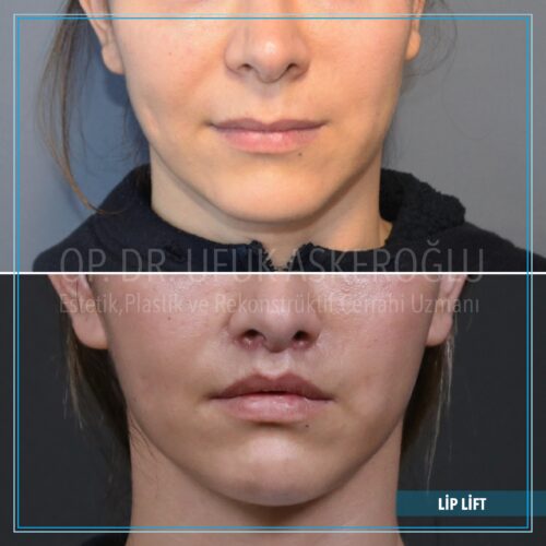Lip Lift Surgery Turkey - Ufuk Askeroğlu