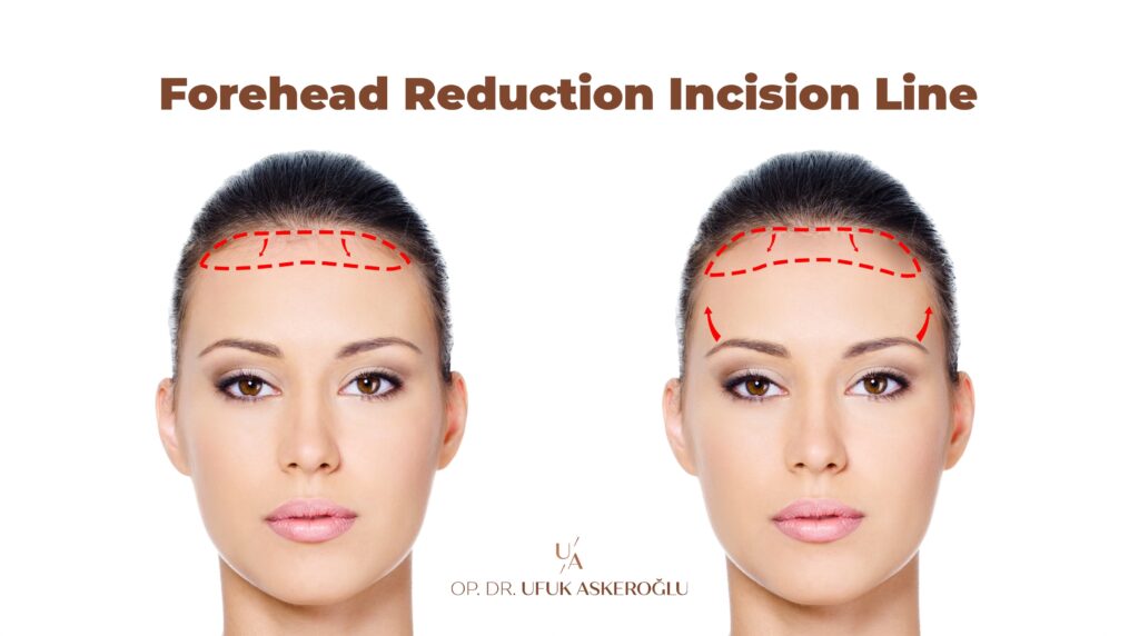 Forehead Reduction Turkey - Ufuk Askeroğlu