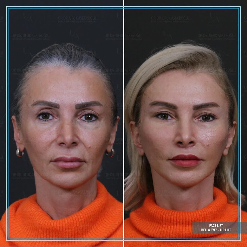 Facelift in Turkey - Ufuk Askeroğlu