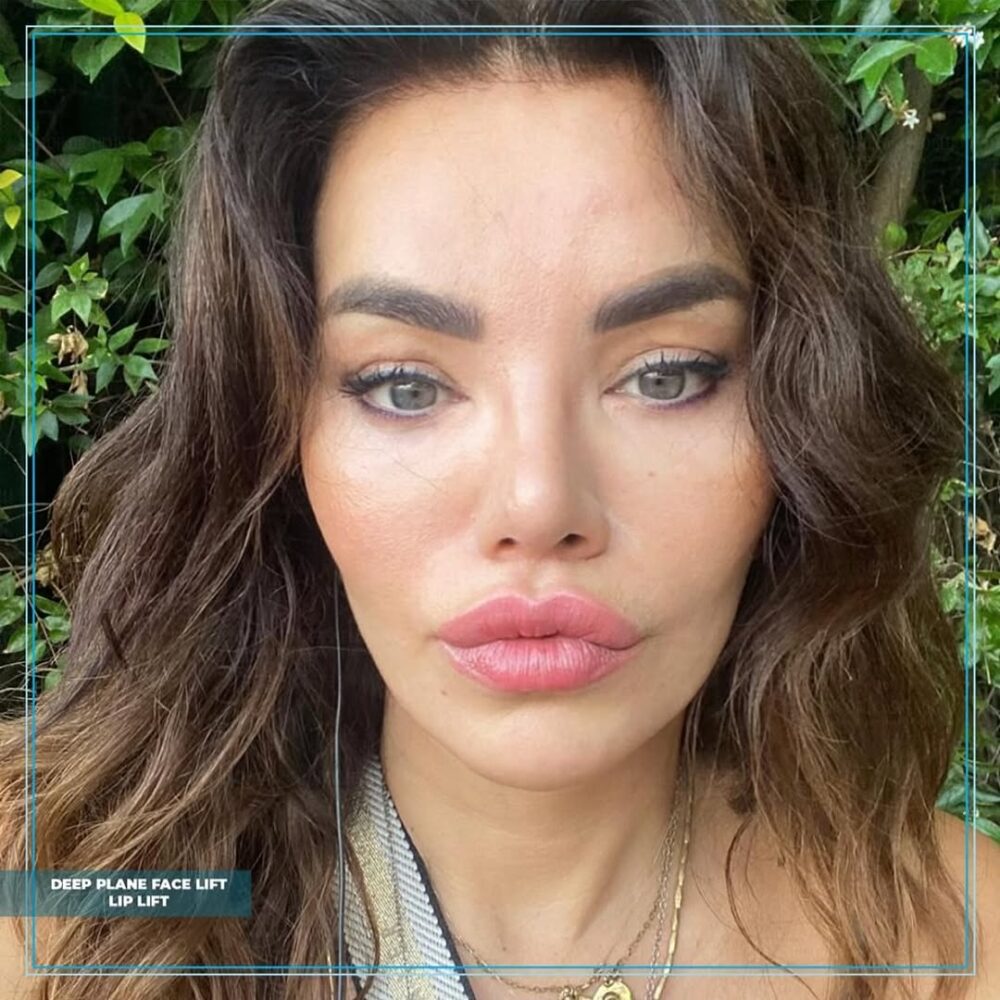 Lip Lift Surgery Turkey - Ufuk Askeroğlu