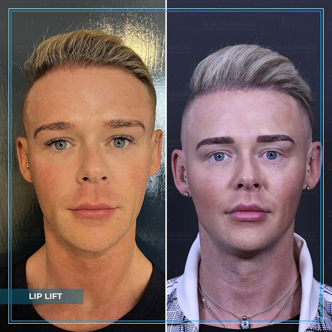 Lip Lift Surgery Turkey - Ufuk Askeroğlu